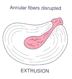 Spinal Disc Herniation Recovery – Fascia First Chiropractic